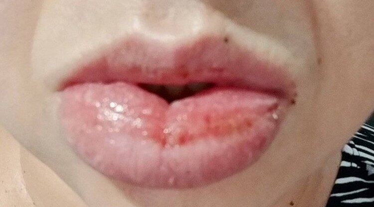 TROUT POUT - Nothing To Smile About Over Toothpaste Allergy